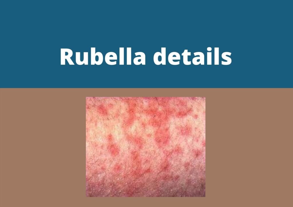 Rubella Details » My Vision Of Health